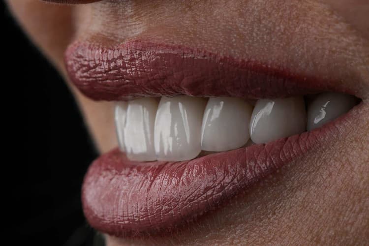 Types of Dentures: Full, Partial and Implant-Supported